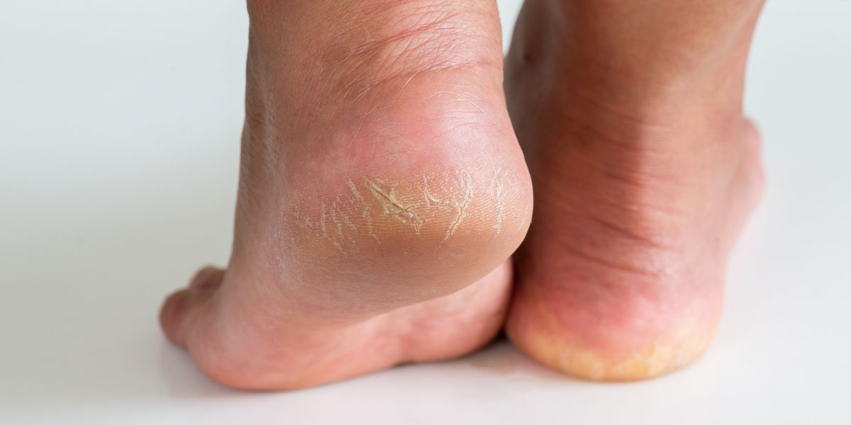 SandBar Callus Care – SandBar Hand Care